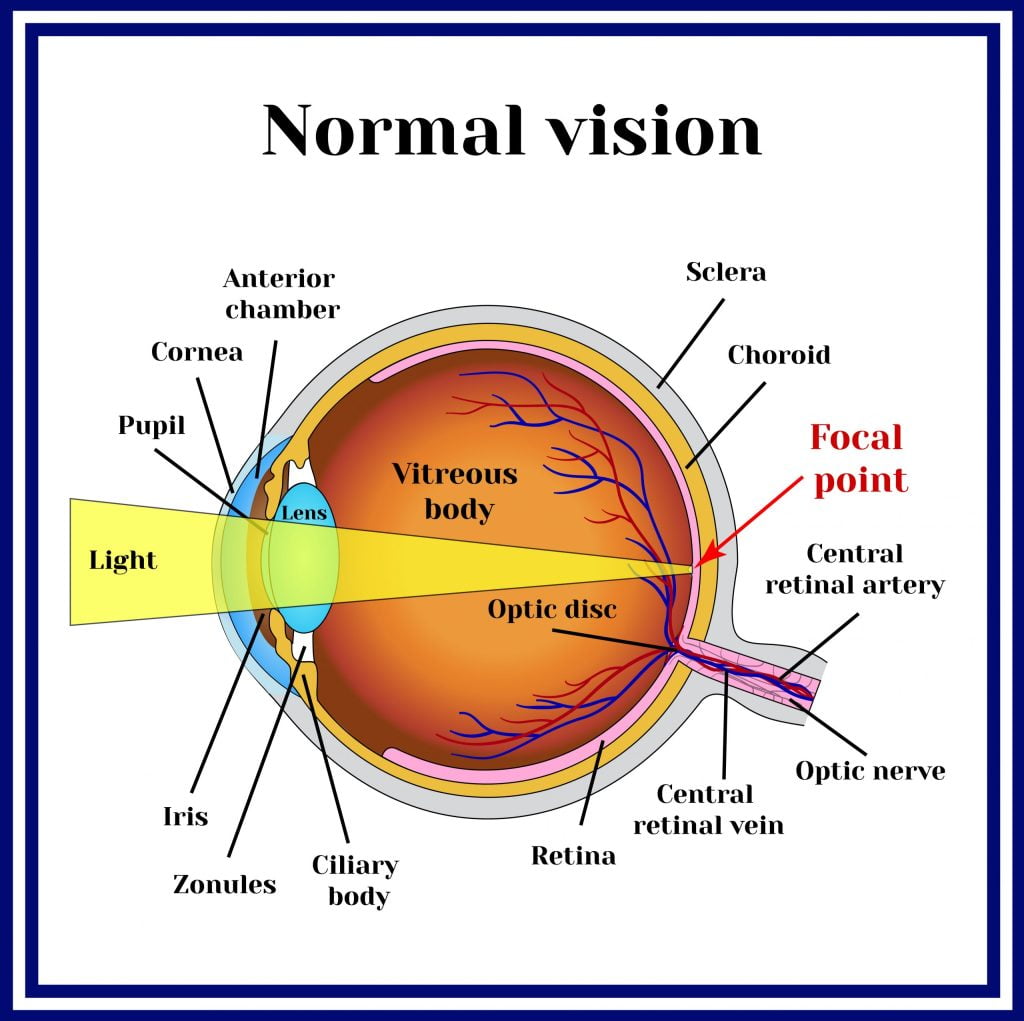 Newark Refractive Eye Surgery Solutions – Eye Care of Delaware