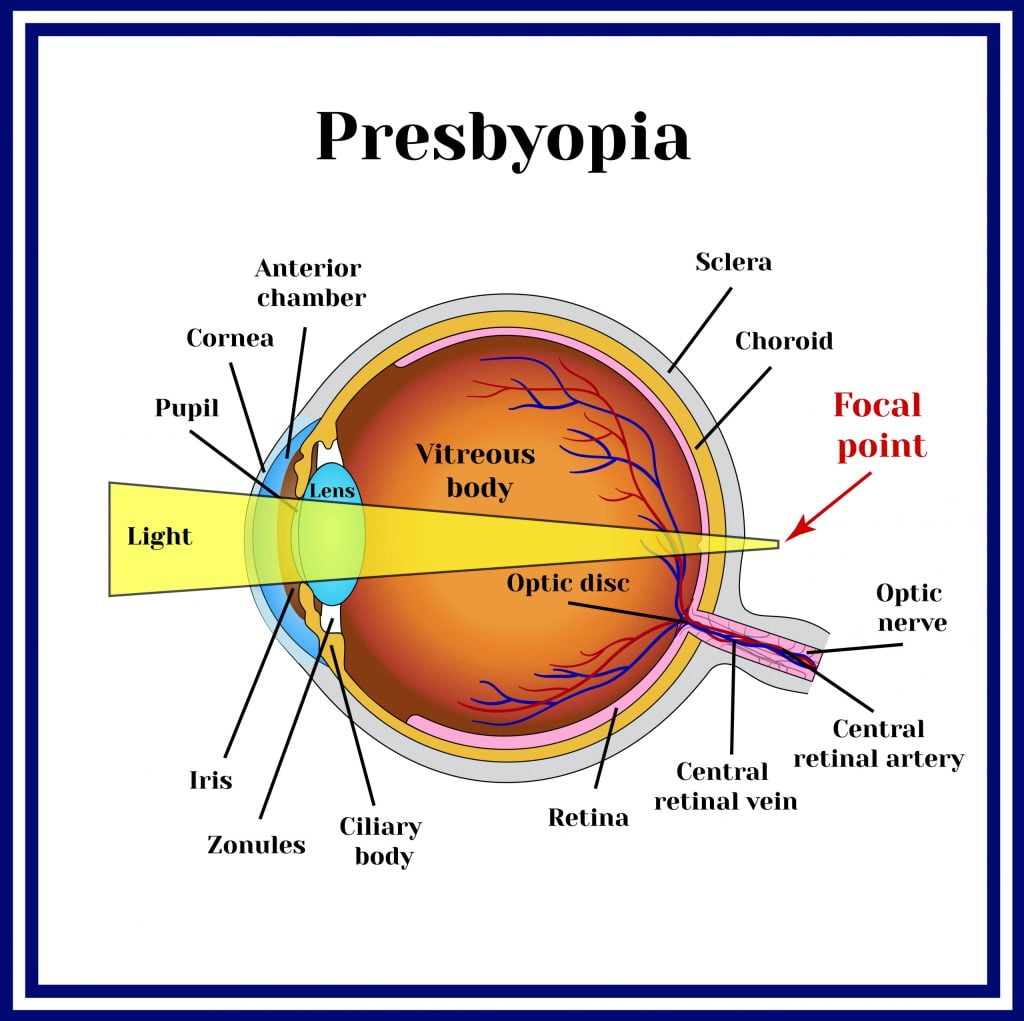 Newark Refractive Eye Surgery Solutions – Eye Care of Delaware